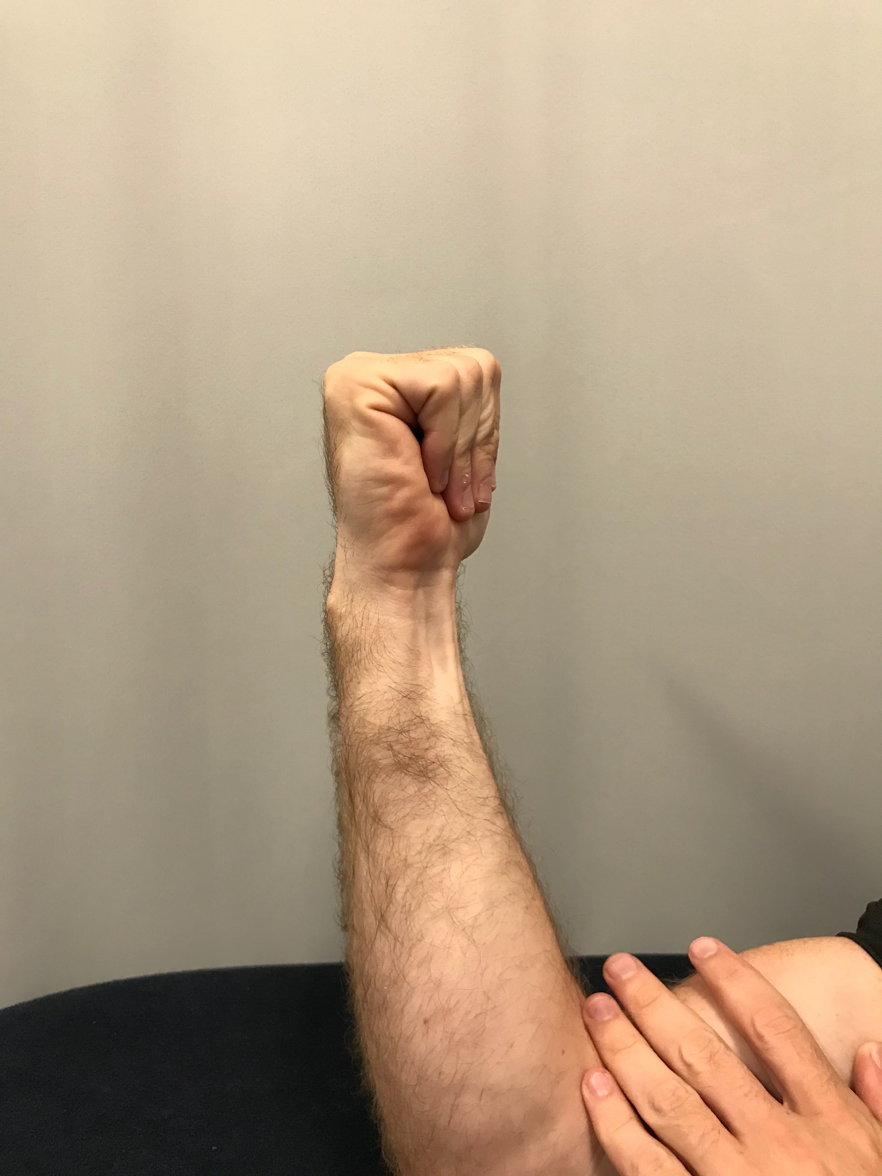 Finger Fractures - Coast Sport